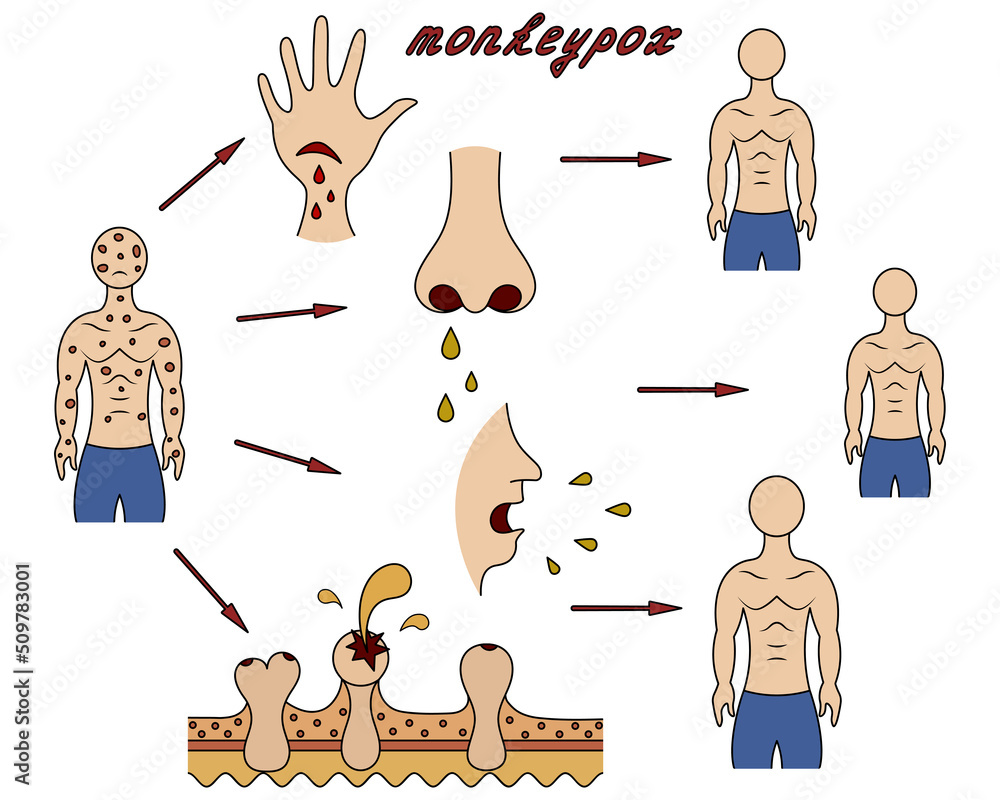 Methods of human infection with monkeypox. Diagram of human-to-human ...