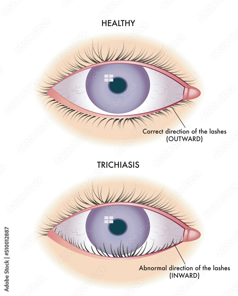 Medical illustration shows the comparison between a normal eye and one ...