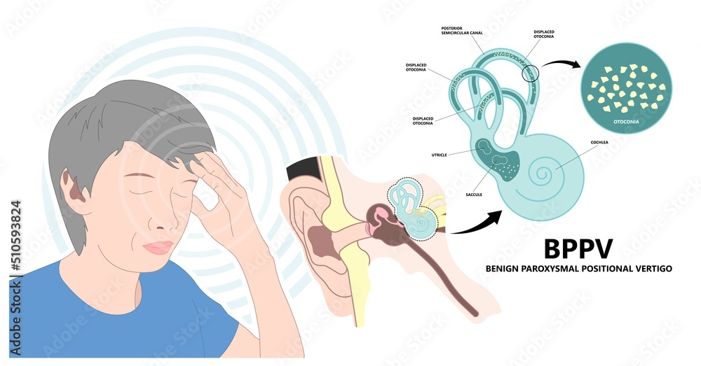 Vector de Stock Benign paroxysmal positional vertigo BPPV loss balance ...