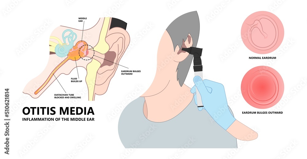 Acute Otitis Media air filled space eardrum treat pain fluid tube pus ...