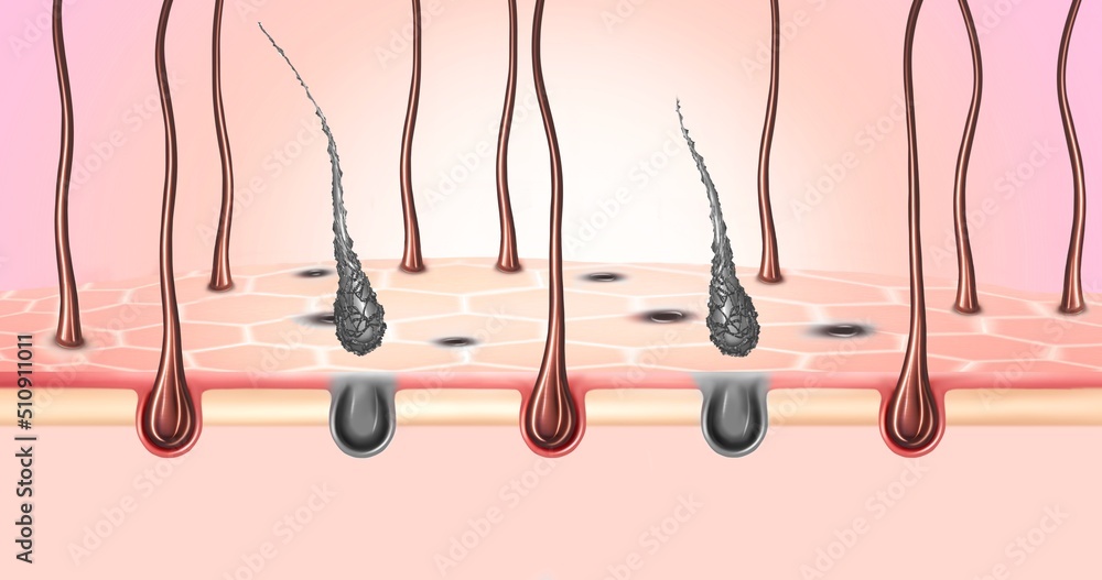 The concept of baldness. 3d illustration of skin layers with hair ...