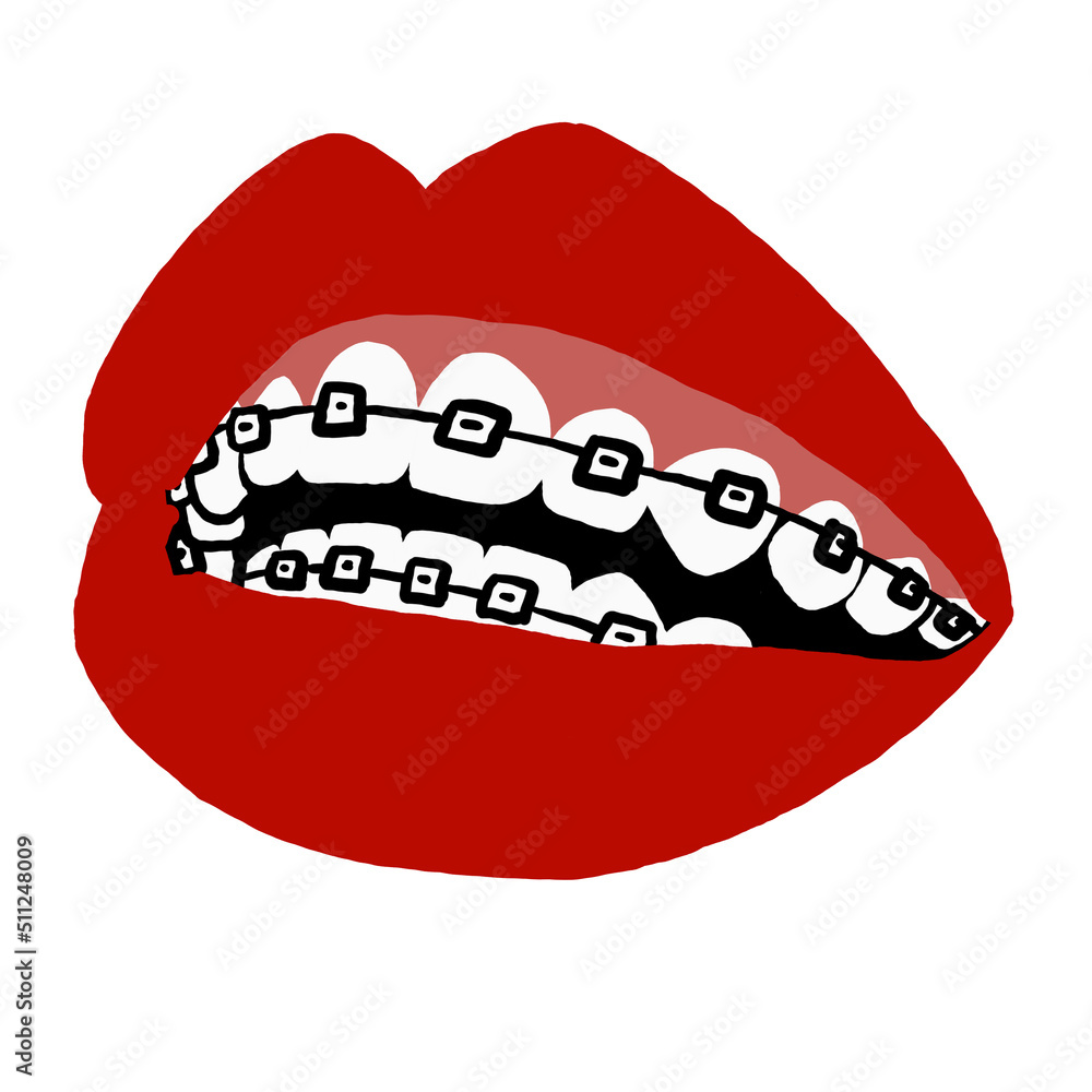 Braces on the teeth. Medical dentist checkup in dental clinic. Tooth ...