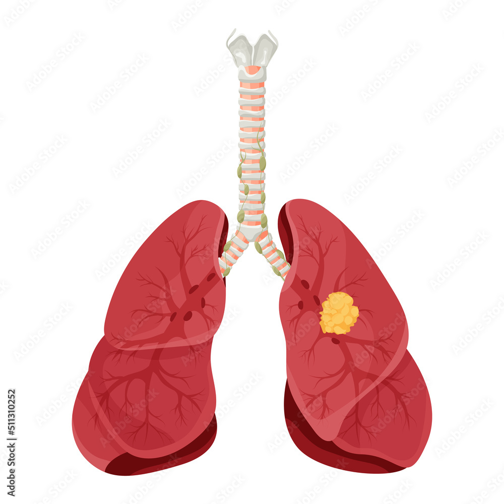 Diagram lung cancer disease. Concept disease human internal organs ...