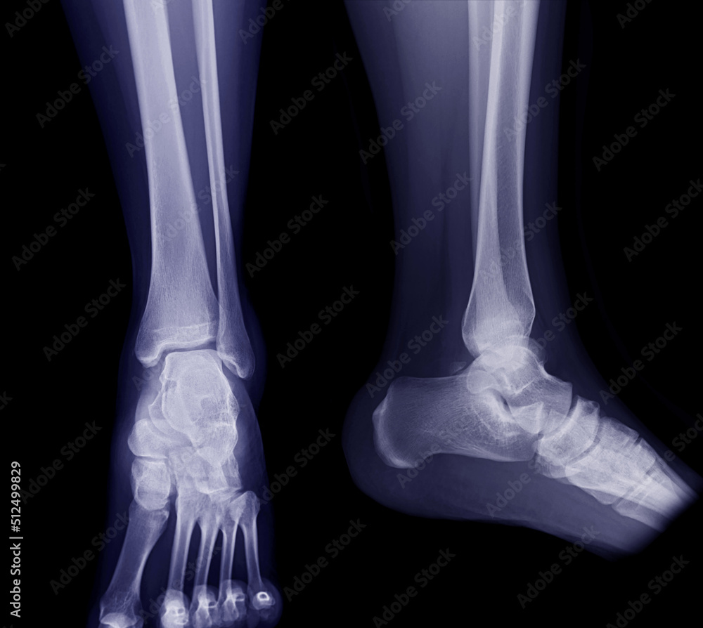 Стоковое фото «X-ray image of ankle joint AP and Lateral view for ...