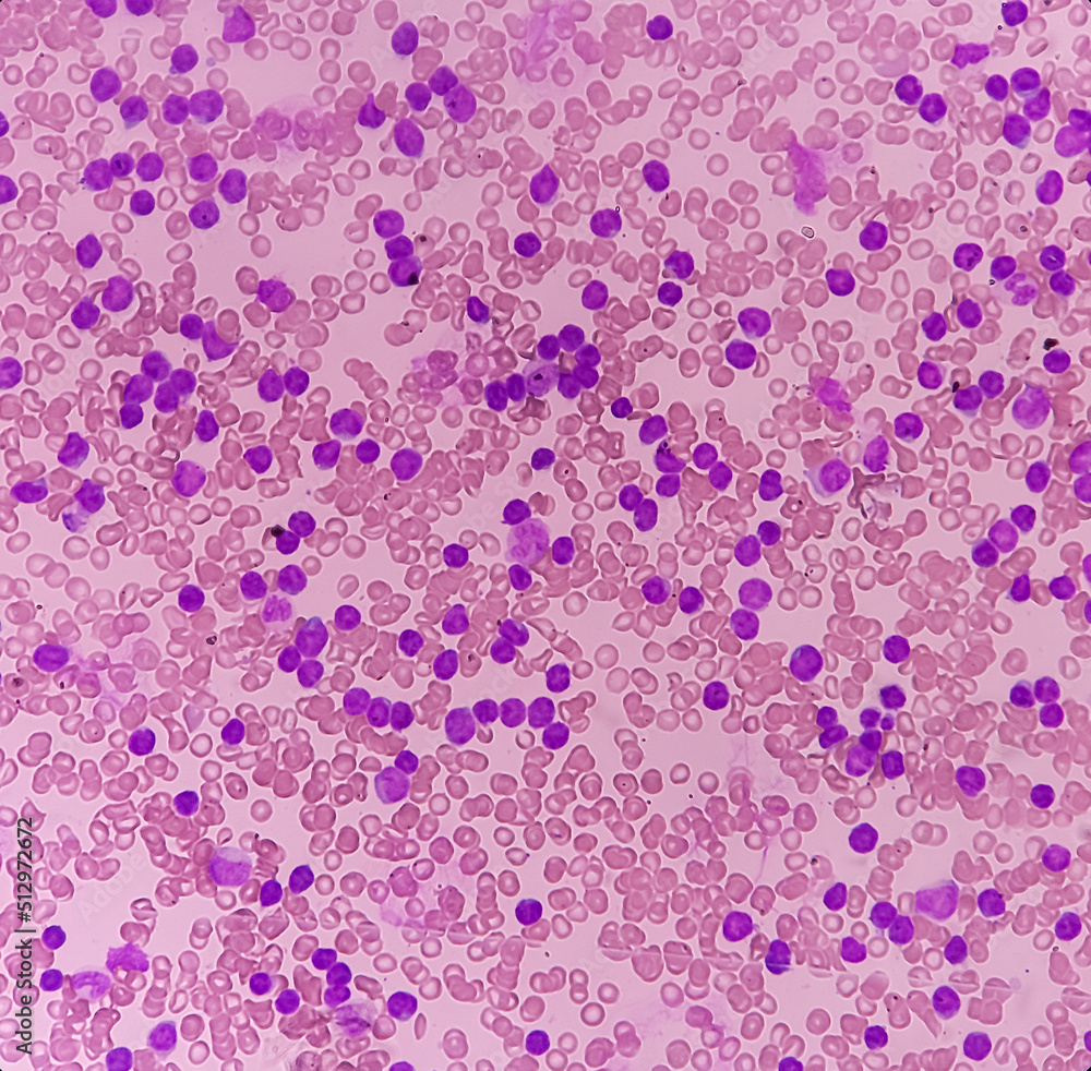 Acute leukemia, peripheral blood smear show most of cell are blast cell ...