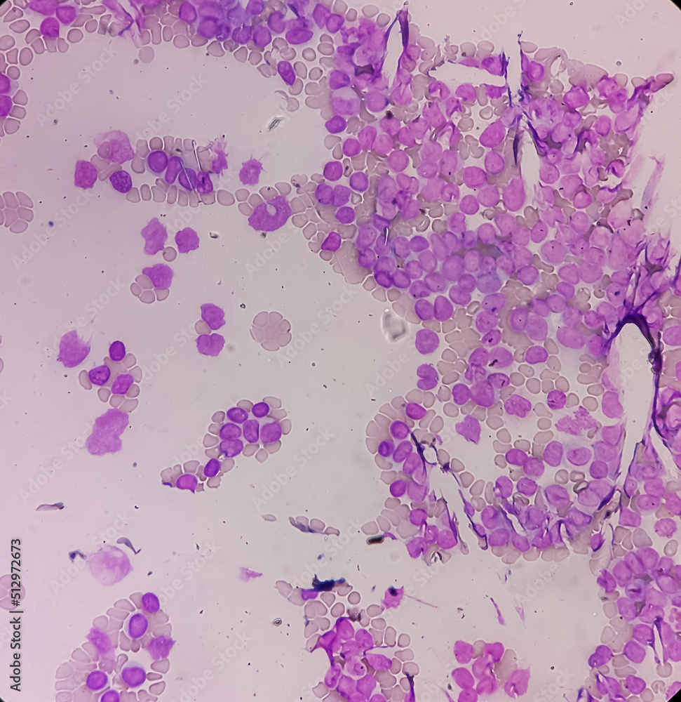 Acute leukemia, peripheral blood smear show most of cell are blast cell ...