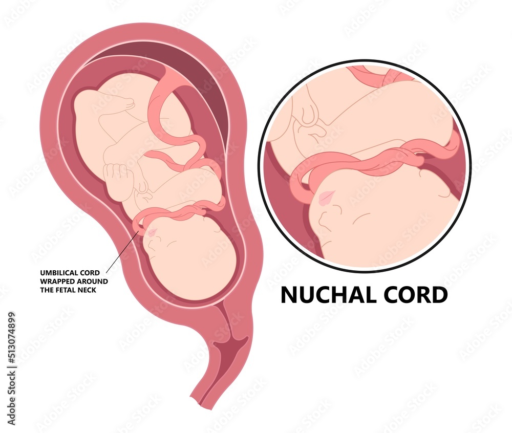 Vektor fetus in womb with Vasa previa Nuchal cord coil c section baby birth fetal neck death ...