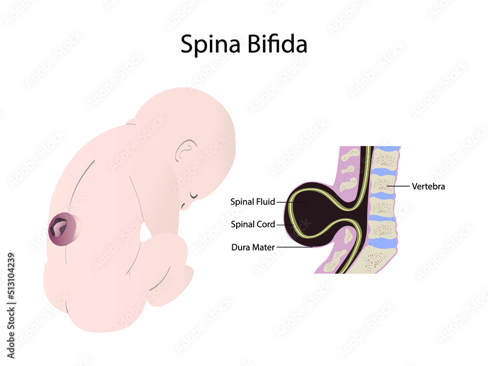 illustration of biology and medical, Illustration of a child with spina ...