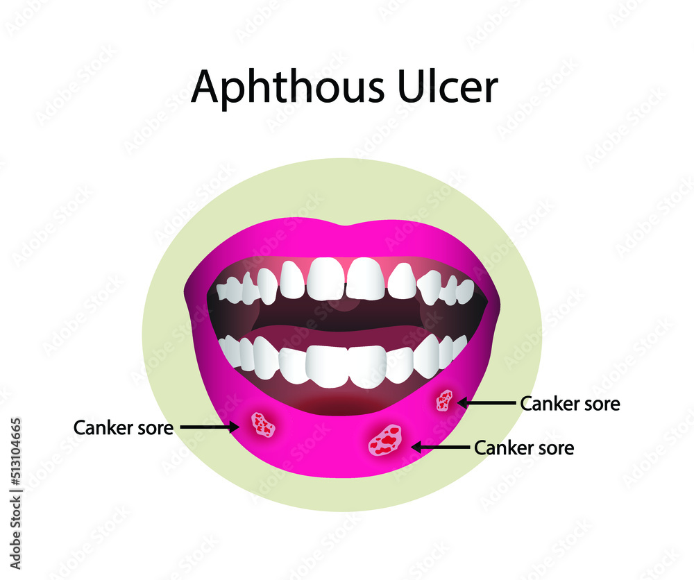 illustration of biology and medical, Aphthous ulcer, Mouth ulcer causes ...