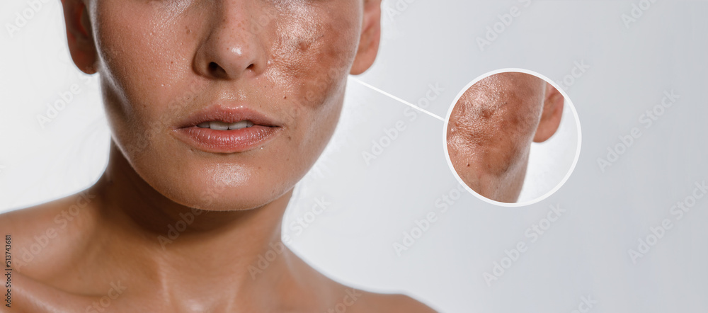 Hyperpigmentation of female skin, close-up of a part of the face on a ...