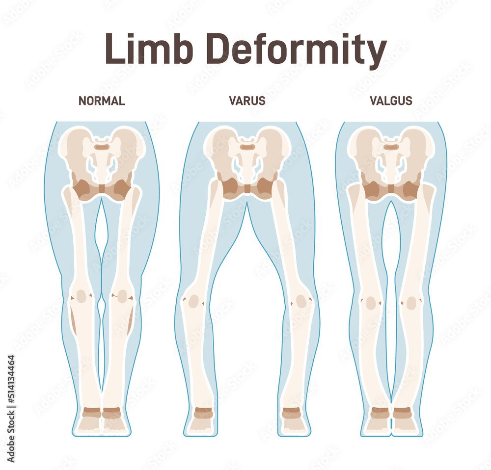Limb anatomy scheme. Valgus and varus leg deformities. Diagram of normal Stock Vector | Adobe Stock
