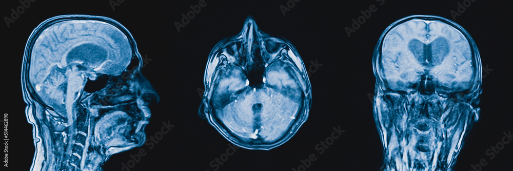 Human brain on MRI scans Frontal, sagittal and transverse sectional ...