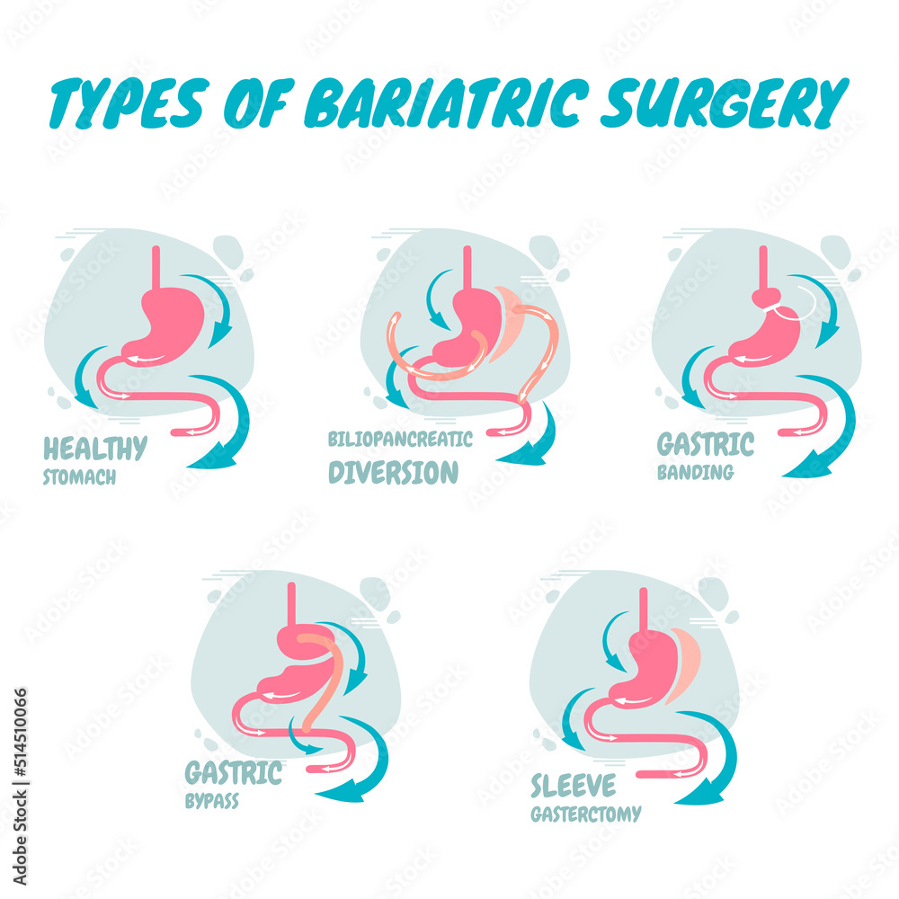Types of bariatric surgery, it is process for the digestive system in ...