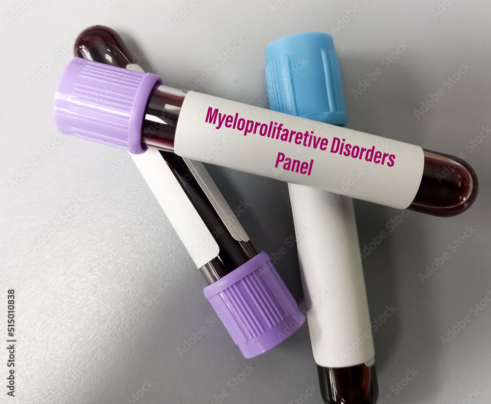Blood sample for Myeloproliferative disorders panel, myeloproliferative ...