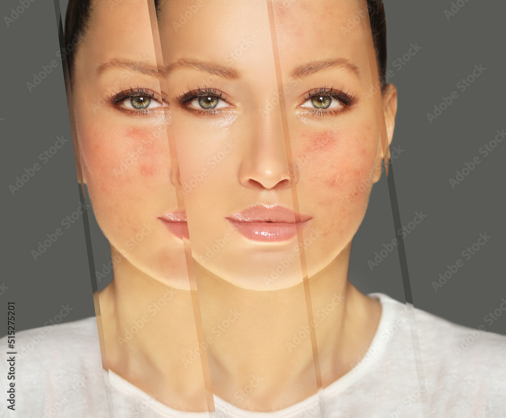 Acne,Skin concern,blemish-prone skin and acne, Rosacea,different types ...