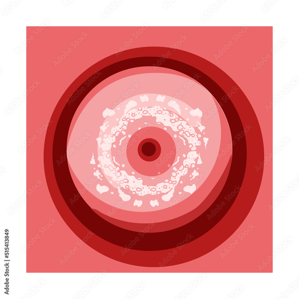 Cervical cancer Dysplasia CIN 1 stage infographic Female reproductive ...