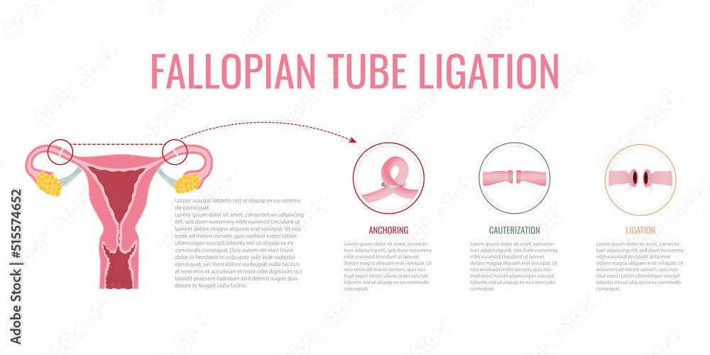 Types Of Tubal Ligation Methods