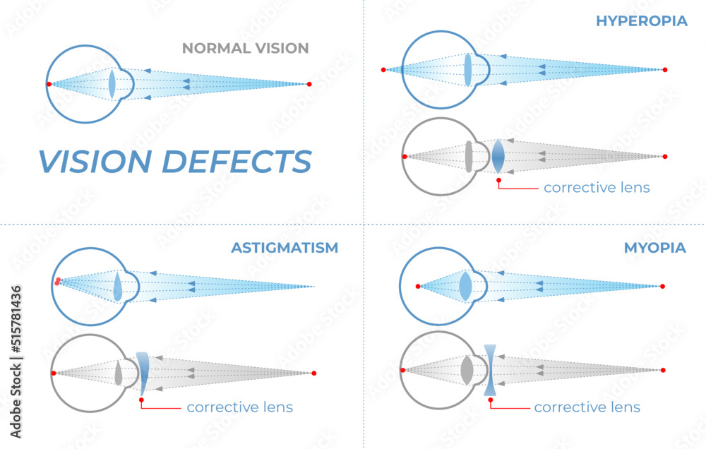 Vision defects and their correction with intraocular lenses. Vision ...
