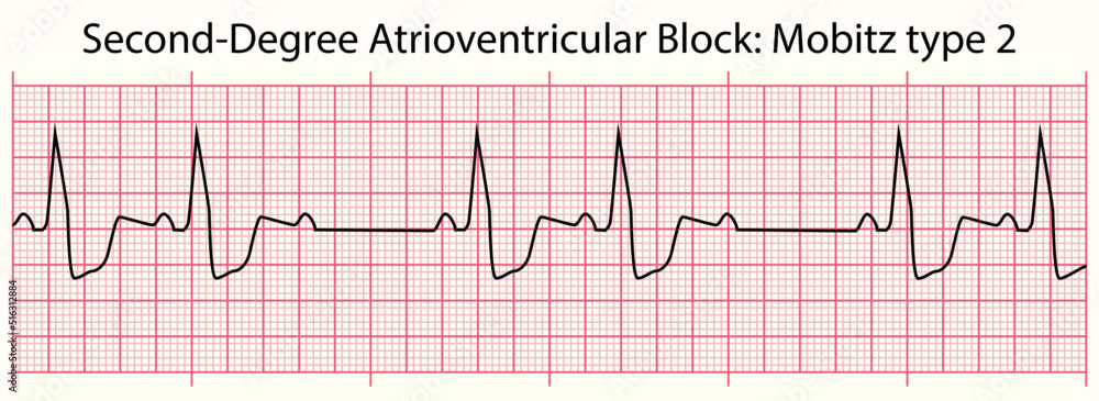 ECG line: Second-Degree Atrioventricular Block: Mobitz type 2 in 6 ...