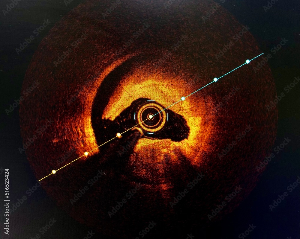 Intravascular imaging Optical Coherence Tomography (OCT) shown ...