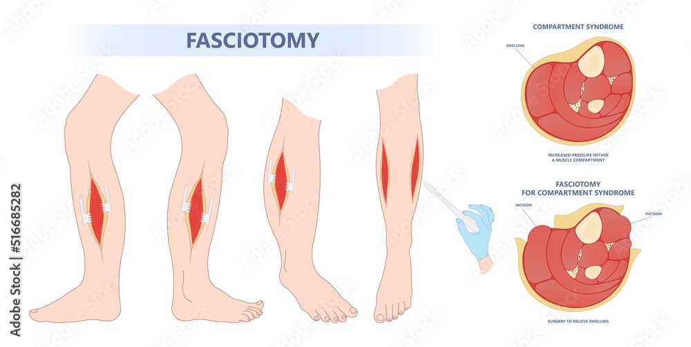 surgery for swollen foot with limb fascia edema disorder the fasciotomy ...