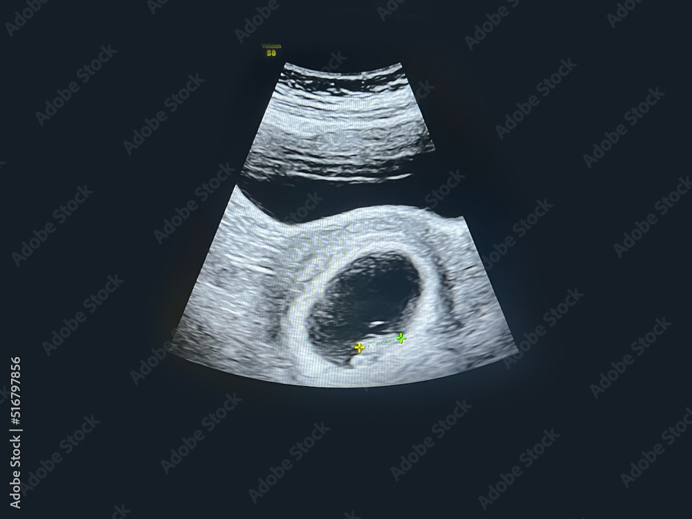 Little baby ultrasound at 8 weeks gestation ultrasound images of the ...