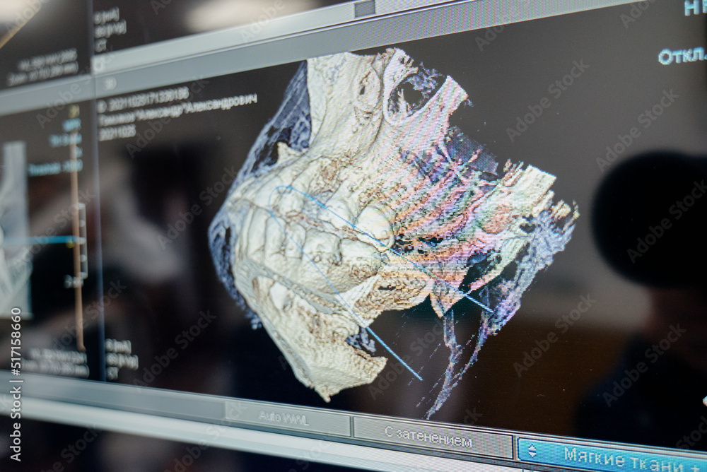 X-ray of the jaw with teeth on a computer monitor. Examination of the ...