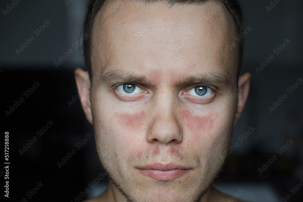 man with allergic dermatitis, red spots on his face. Autoimmune disease ...
