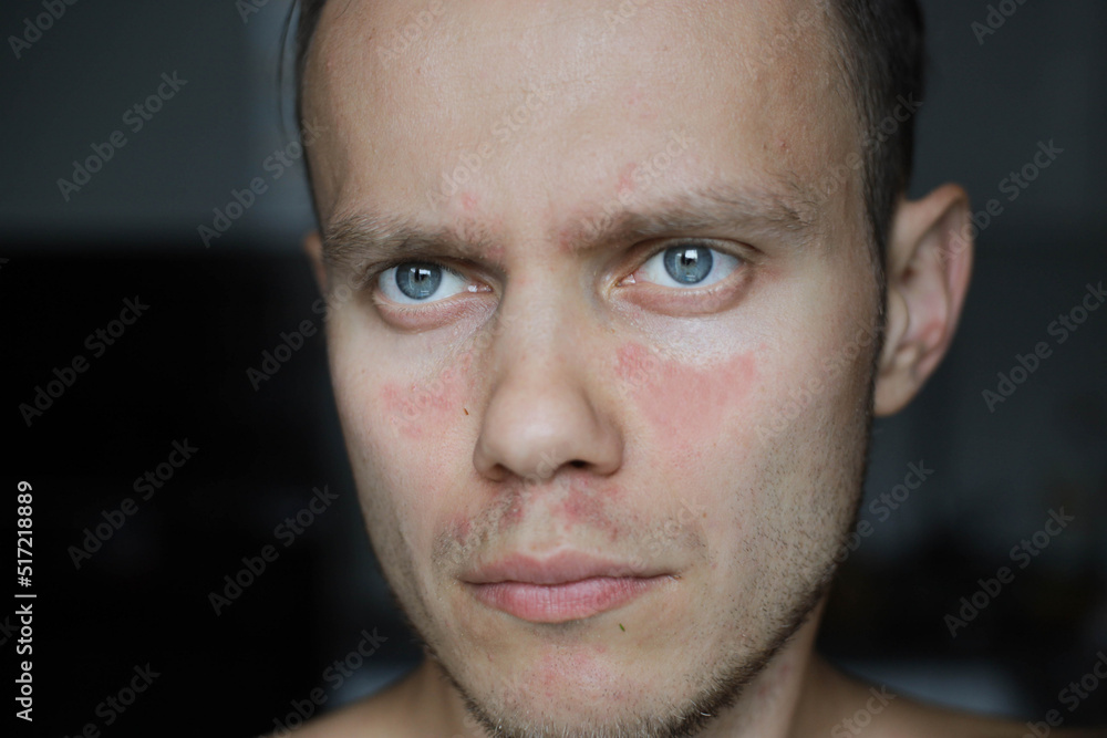 man with allergic dermatitis, red spots on his face. Autoimmune disease ...
