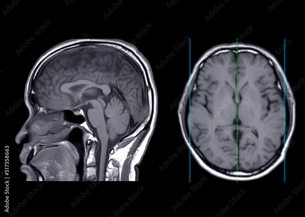 MRI brain axial T1W plane sagittal and axial view . の Stock フォト | Adobe Stock