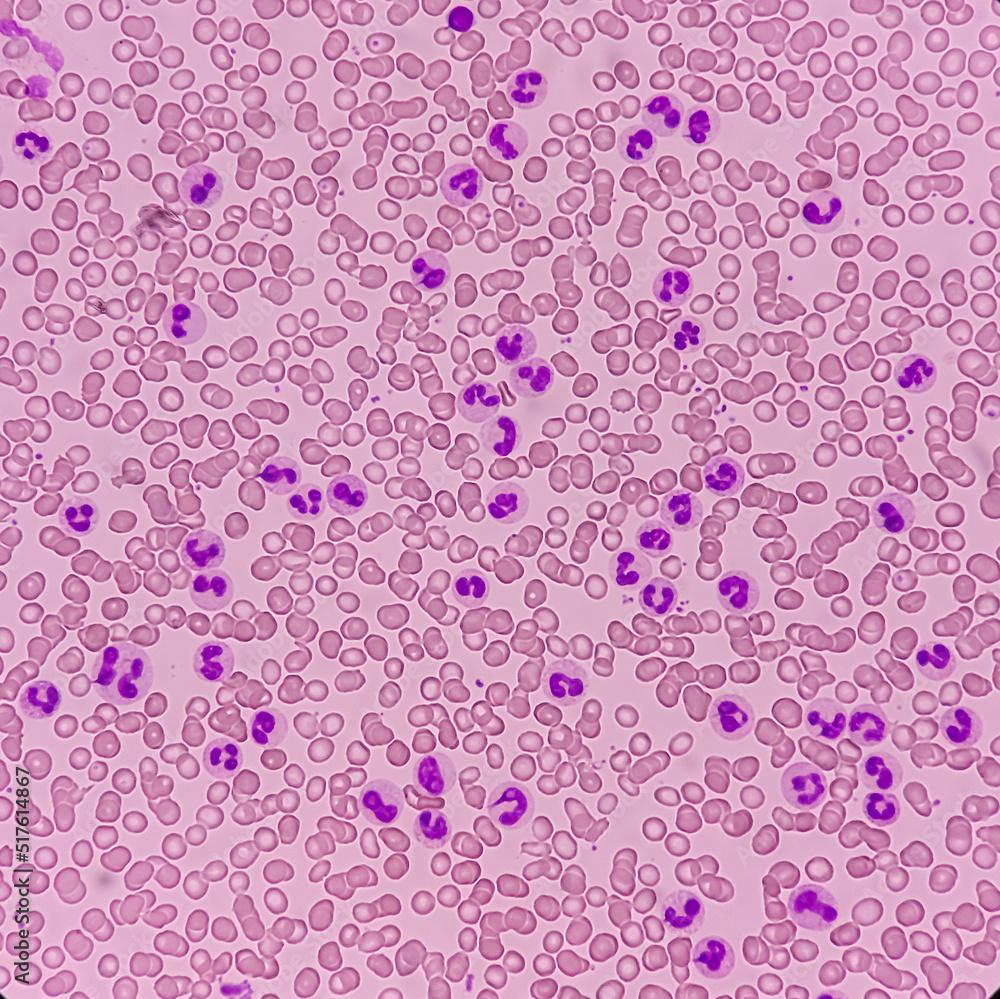 Foto de Stock Neutrophilic leukocytosis, increase total count of White ...