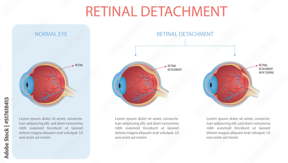 Infographic of a normal eye and an eye with retinal detachment, two ...