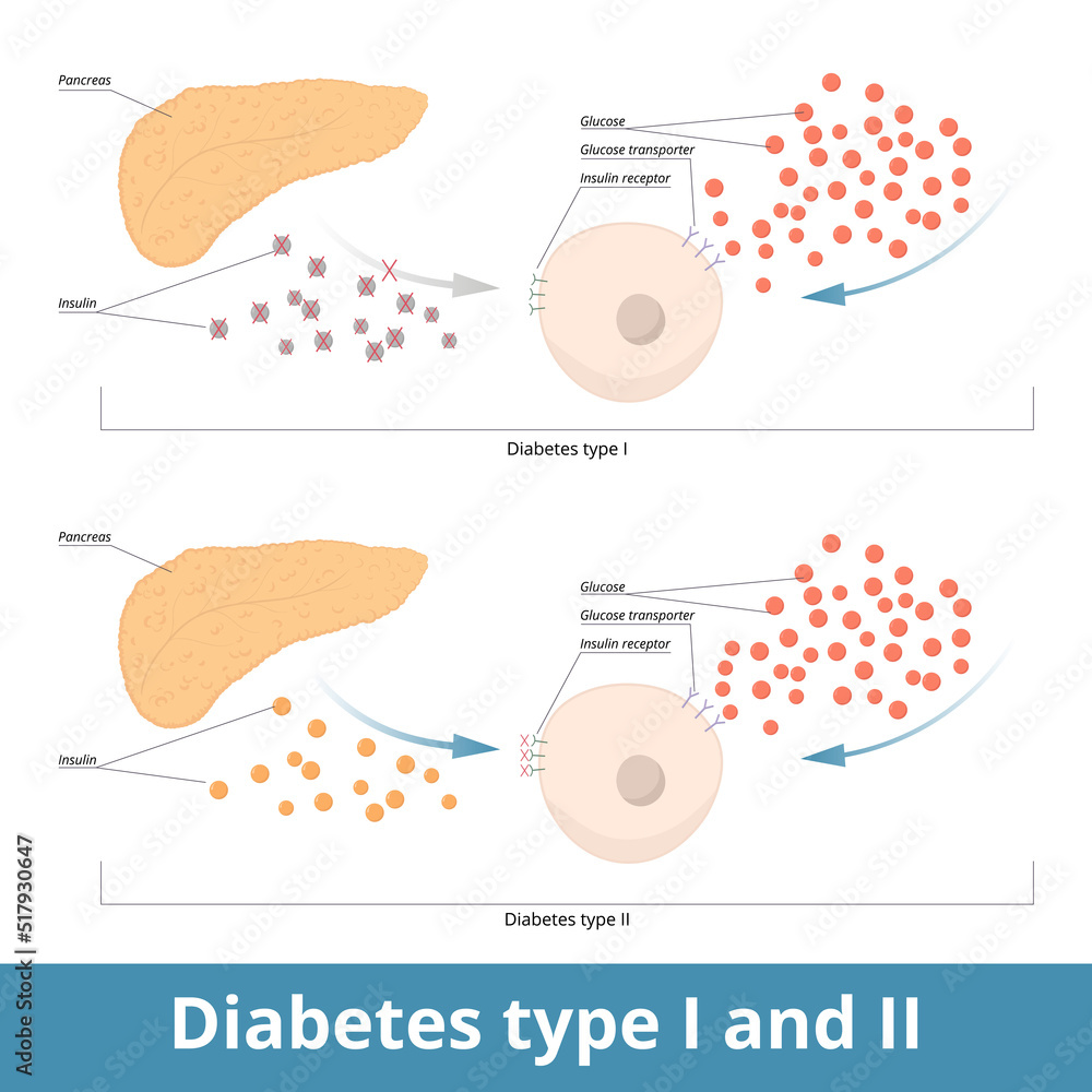 Stock-Vektorgrafik „Diabetes type I and II. Schematic visualization of ...