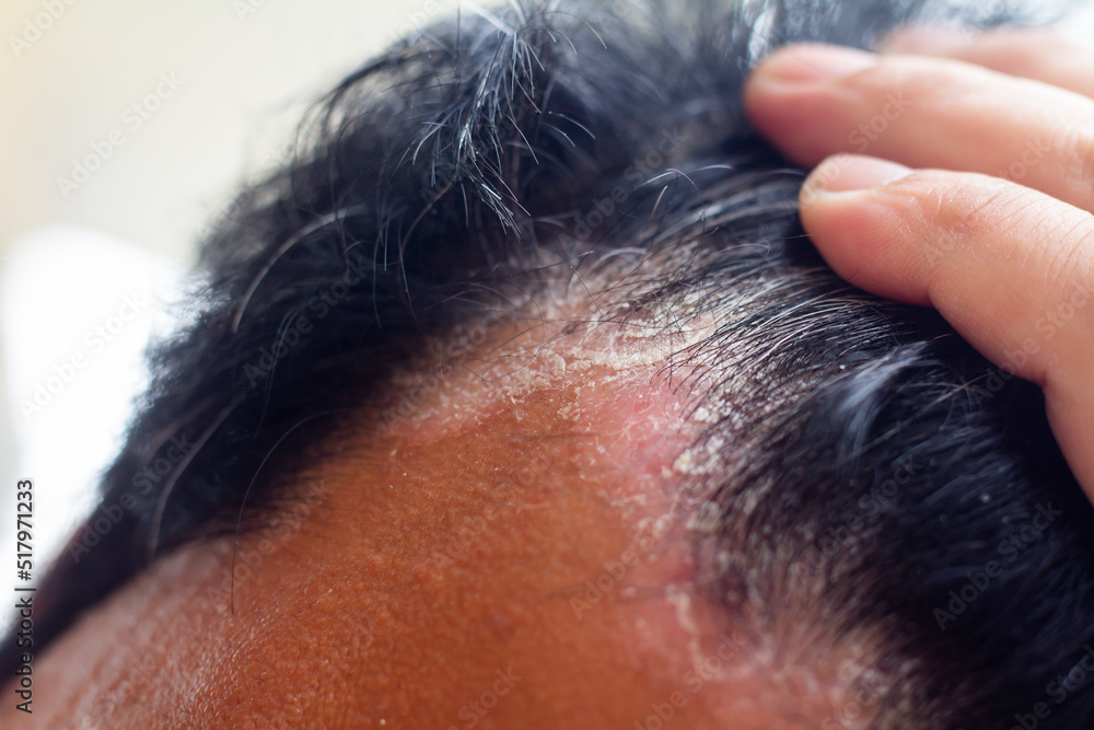 skin disease at the head, Dandruff is a common condition that causes ...