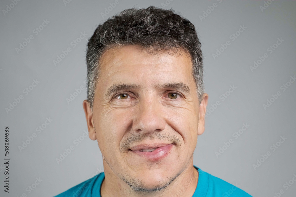 Allergic reaction to a bee sting. An unshaven man was stung by a bee ...