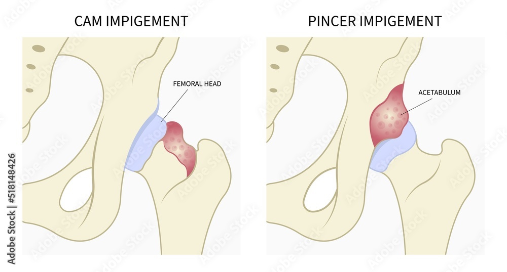 Impigement syndrome of hip bone Pain range of motion with head tear ...