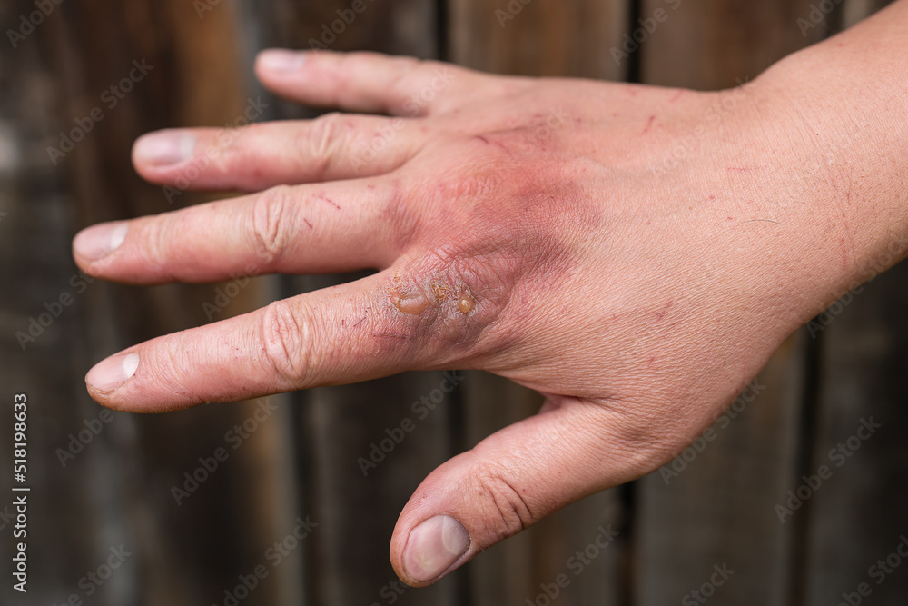 First degree skin burn. Hand burns, wounds. Hot boiling water acts on ...