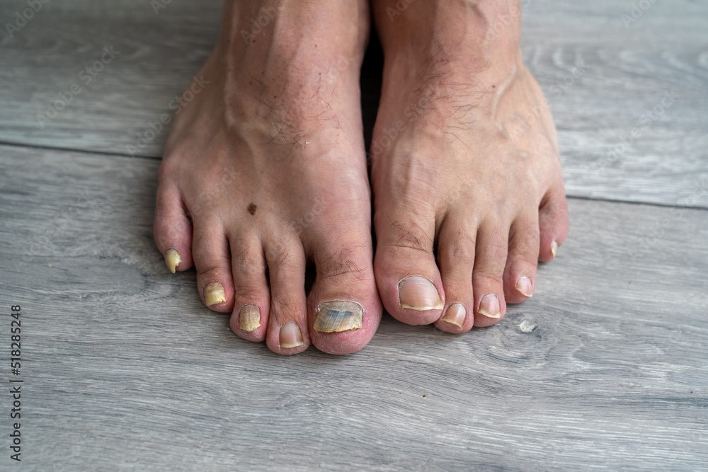 male man feet close up, nail fungus, skin and nail infection, toe ...