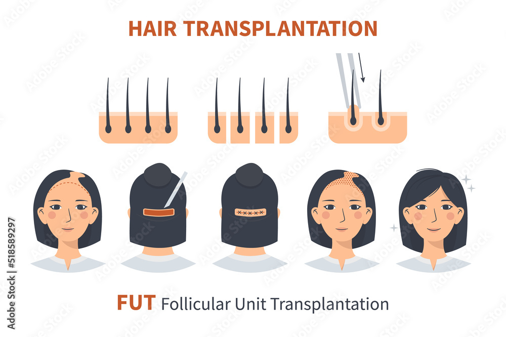 Stages of woman hair transplantation FUT Follicular Unit. Treatment ...