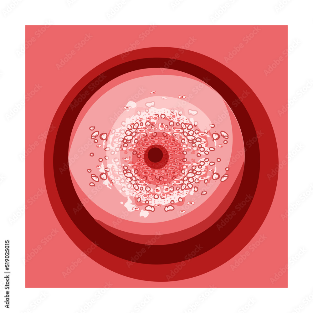 Стоковое векторное изображение «Cervical cancer Dysplasia CIN 2, 3 ...