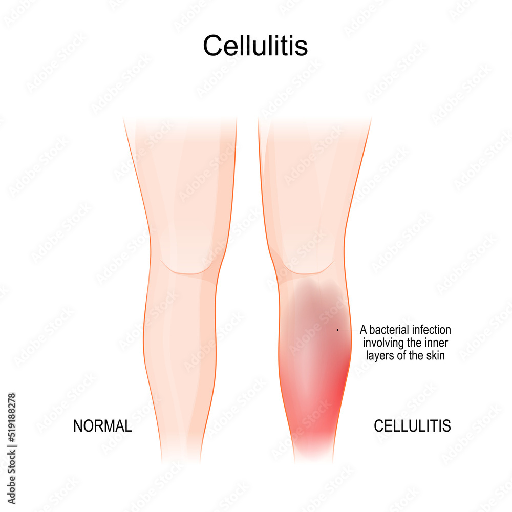 Skin cellulitis. Healthy leg, and leg with symptoms of Infectious ...