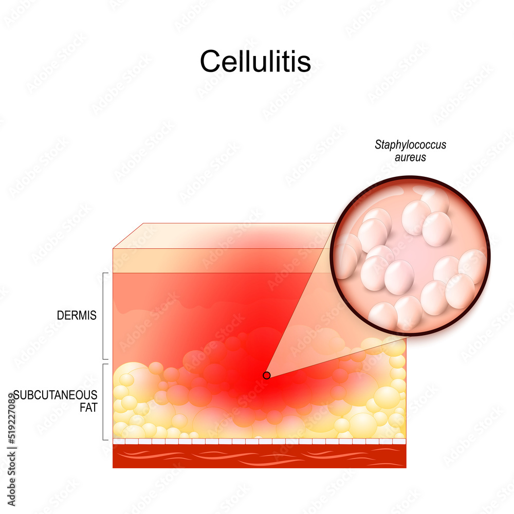 cellulitis. Cross section of layers of the human Skin with symptoms of ...