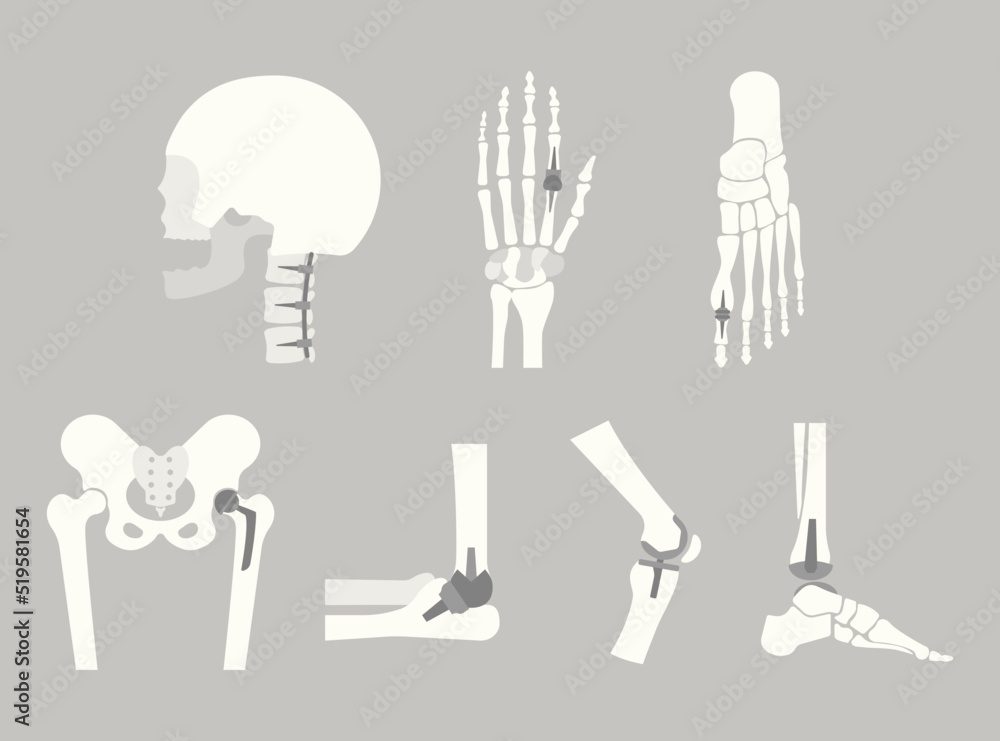 Joint implants in human skeleton cartoon illustration set. Different ...
