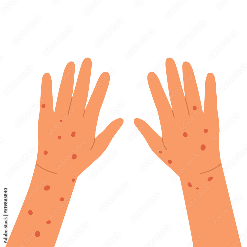 Red rash on hands. Allergy, dermatitis, psoriasis or eczema. Hands ...