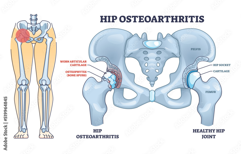 Hip osteoarthritis bone disease with painful skeletal spurs outline ... Hip osteoarthritis bone disease with painful skeletal spurs outline ...