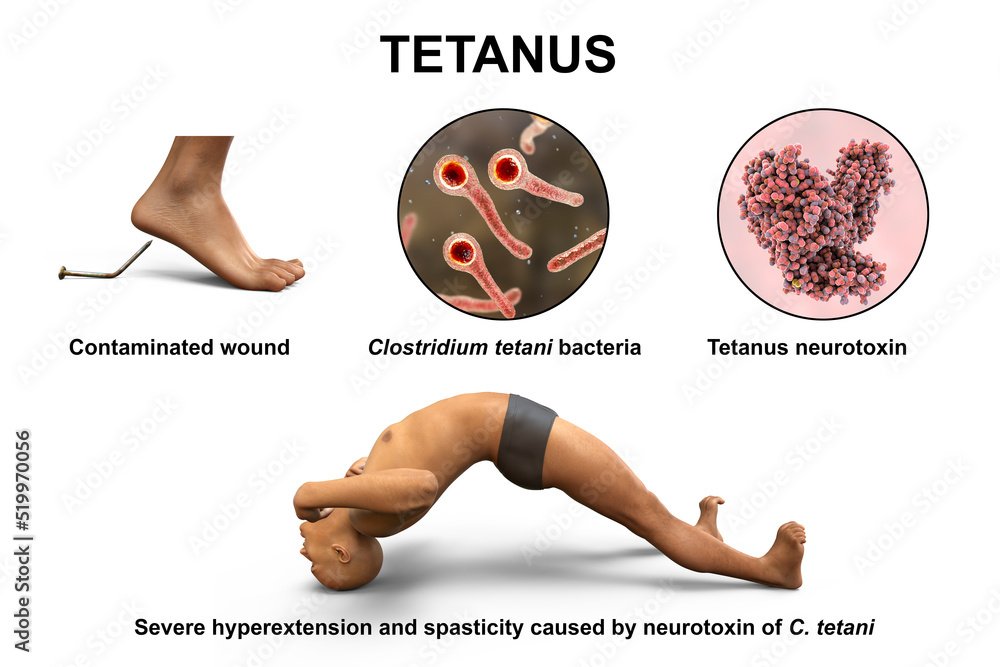 Ilustración de Stock Tetanus disease, opisthotonus in a man suffering ...