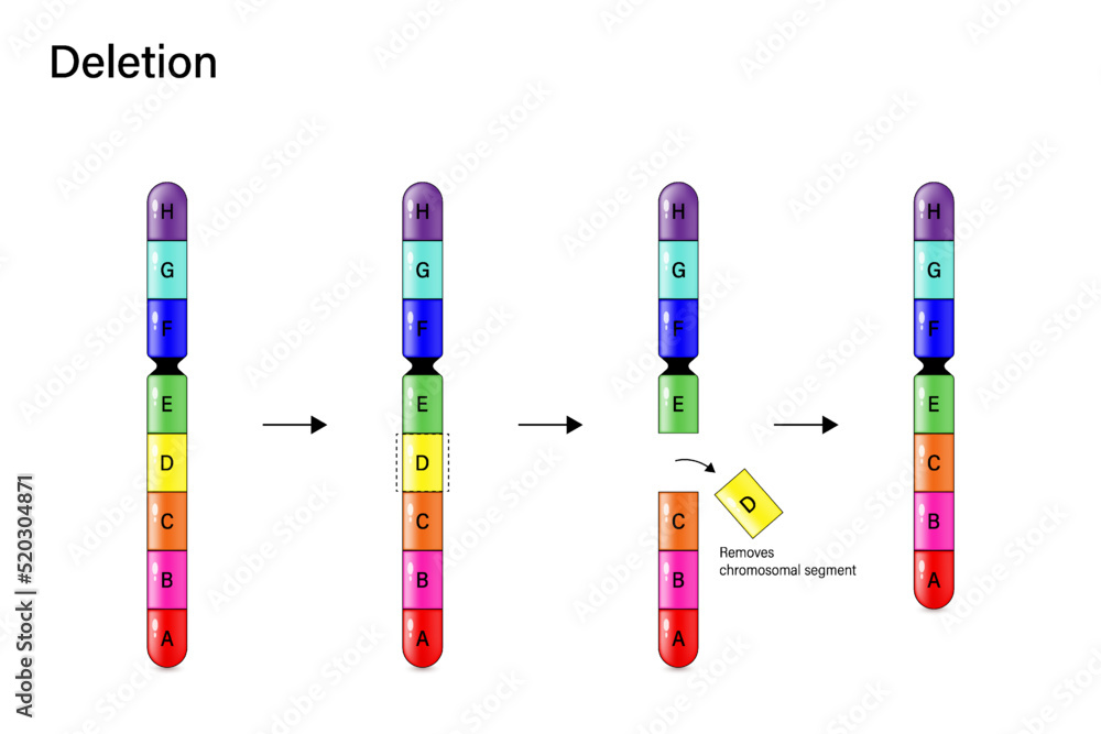 Chromosome Deletion. Genetic mutation. Alteration of chromosome ...