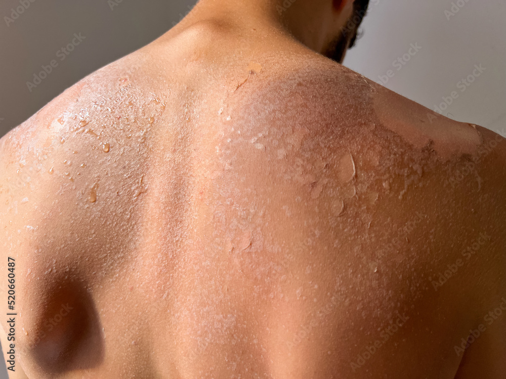 ภาพถ่าย Stock Peel back and shoulder skin from sunburn effect on young ...