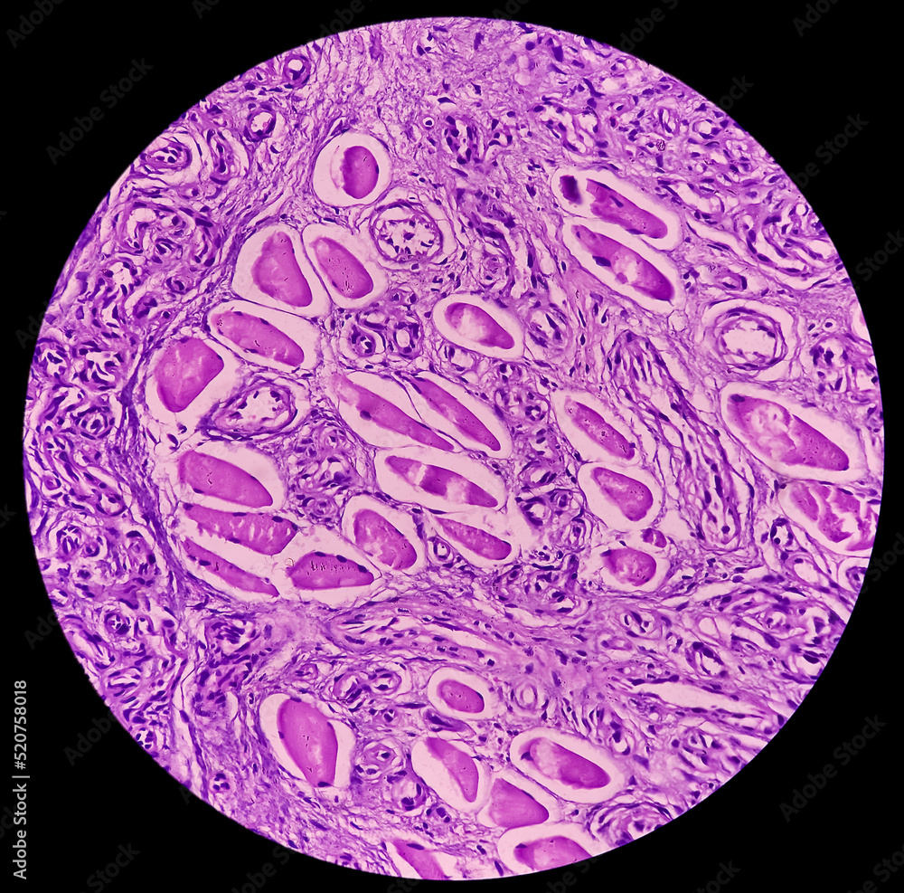 Vascular tumor of scalp biopsy: Intramuscular hemangioma, benign tumor ...