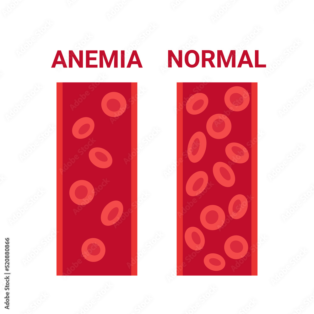 Normal and anemia blood in vessel comparison, number circulation cells ...